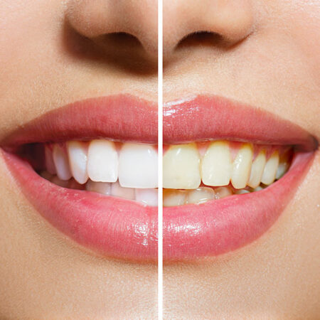 6 Solutions: How to Fix Discolored Teeth