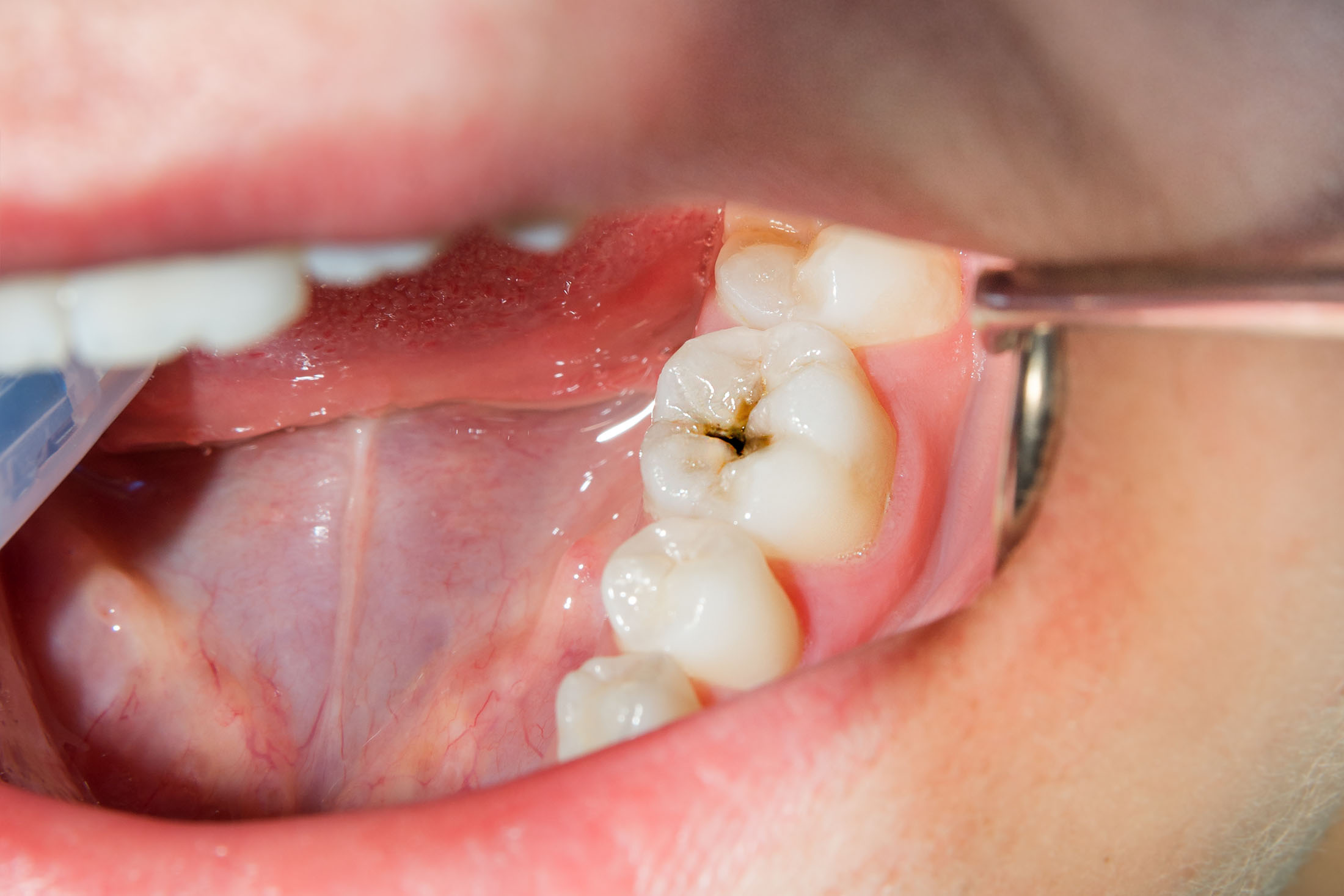 What Do Cavities Actually Look Like?