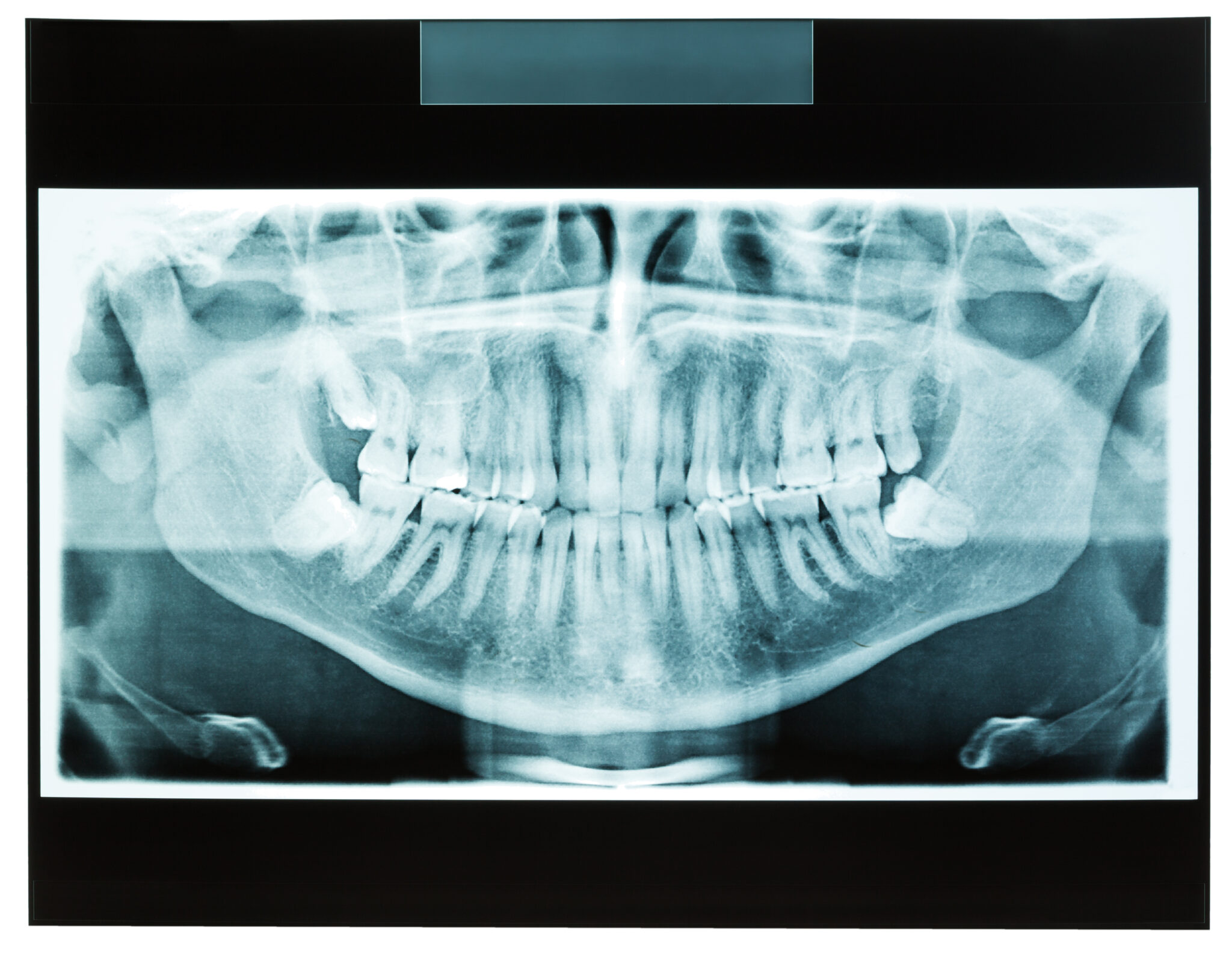 How to Identify Bone Loss in Jaw: Early Signs to Watch For - myDental