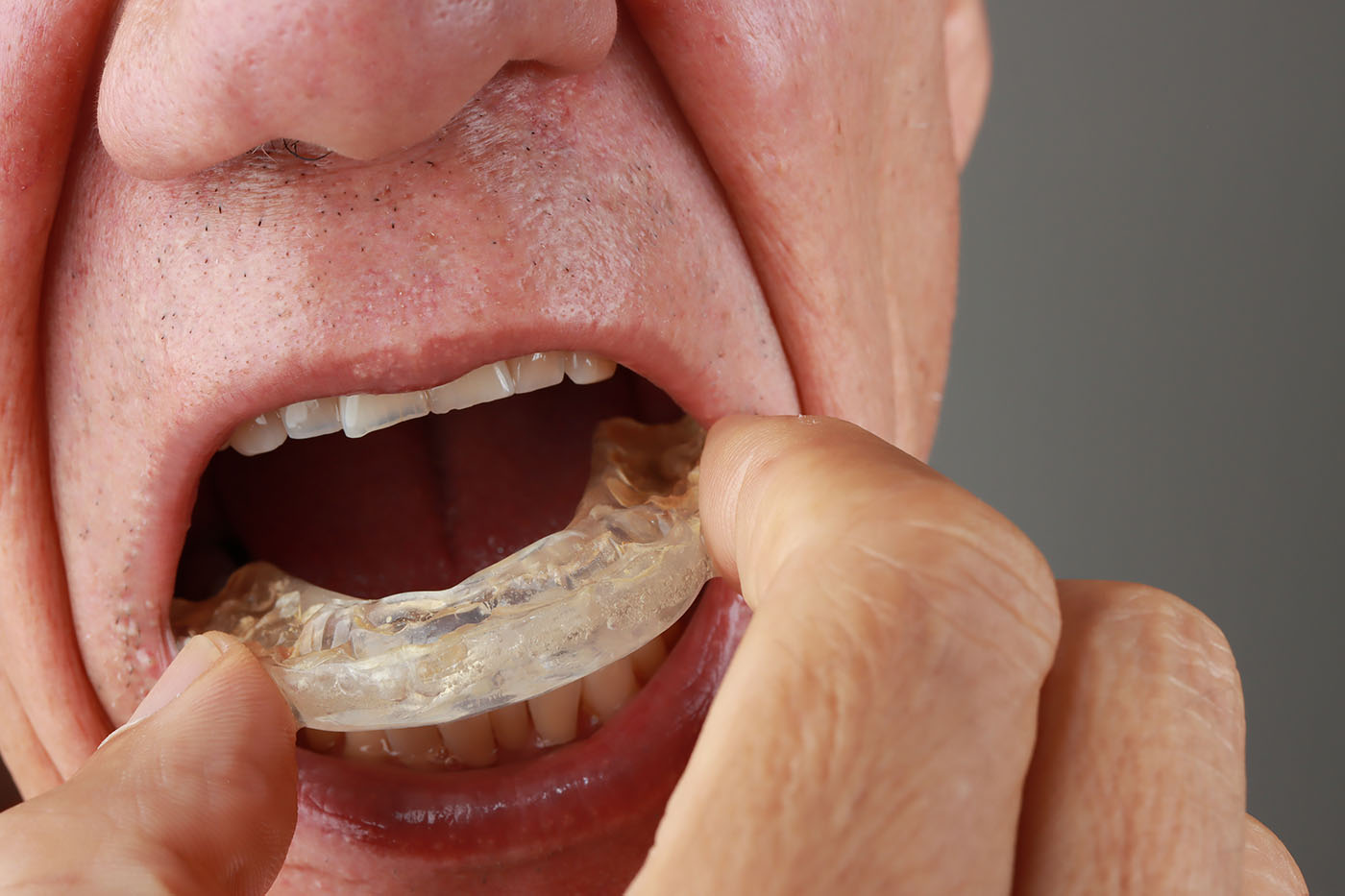 The Long-Term Effects of Teeth Grinding: More Than Just Tooth Wear ...
